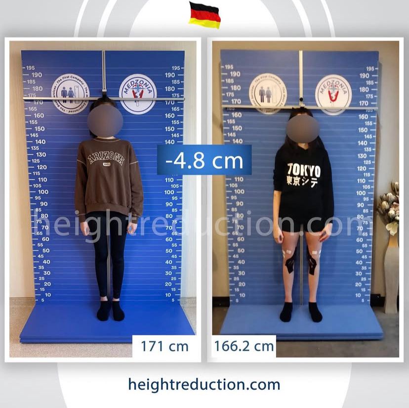 WHAT IS HEIGHT REDUCTION SURGERY? A DETAILED GUIDE - Wanna Be Taller