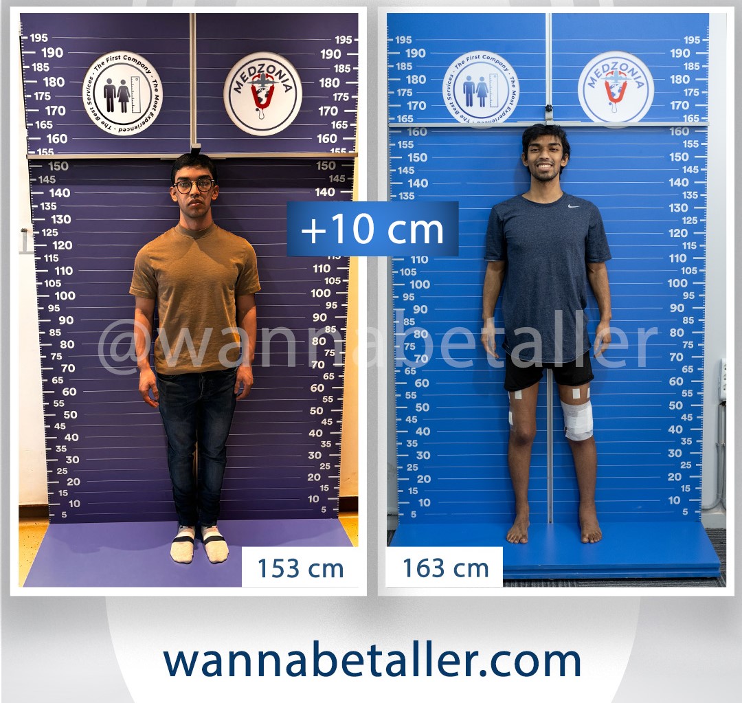 Growth Plates: What They Are, When They Close, and Do They Reopen ...