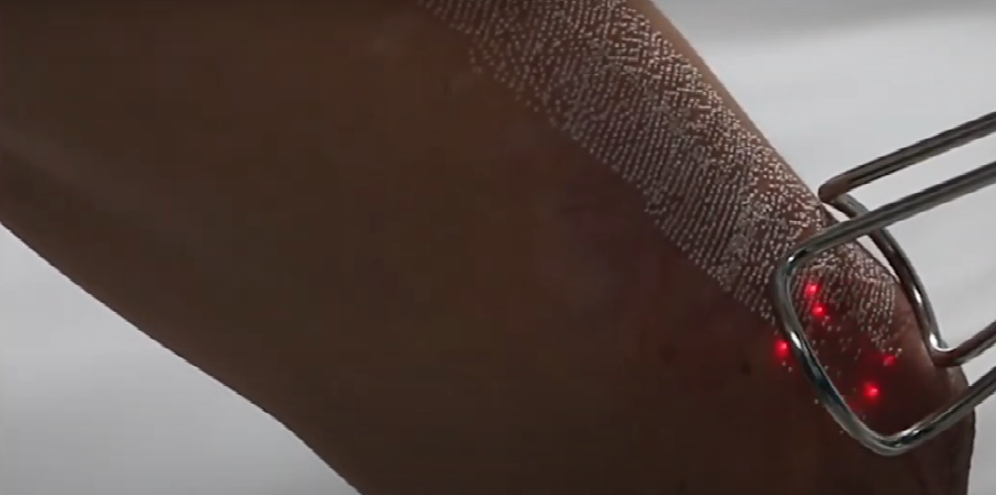 Scars After Leg Lengthening Surgery: Types and Solutions - Wanna Be Taller