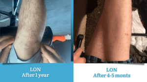 Scars After Leg Lengthening Surgery: Types and Solutions - Wanna Be Taller