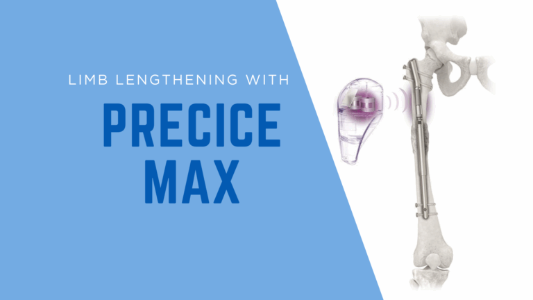 Limb Lengthening with the Precice Max Method - Wanna Be Taller