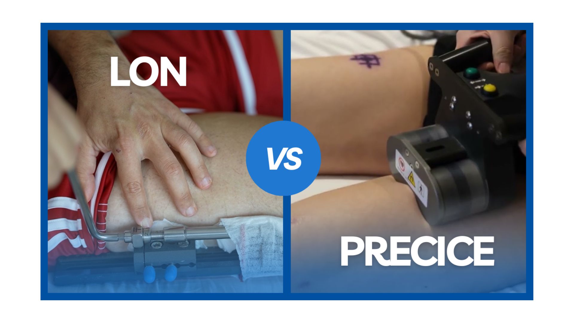 LON vs. PRECICE: Which Limb Lengthening Method Fits Your Goal? - Wanna Be Taller