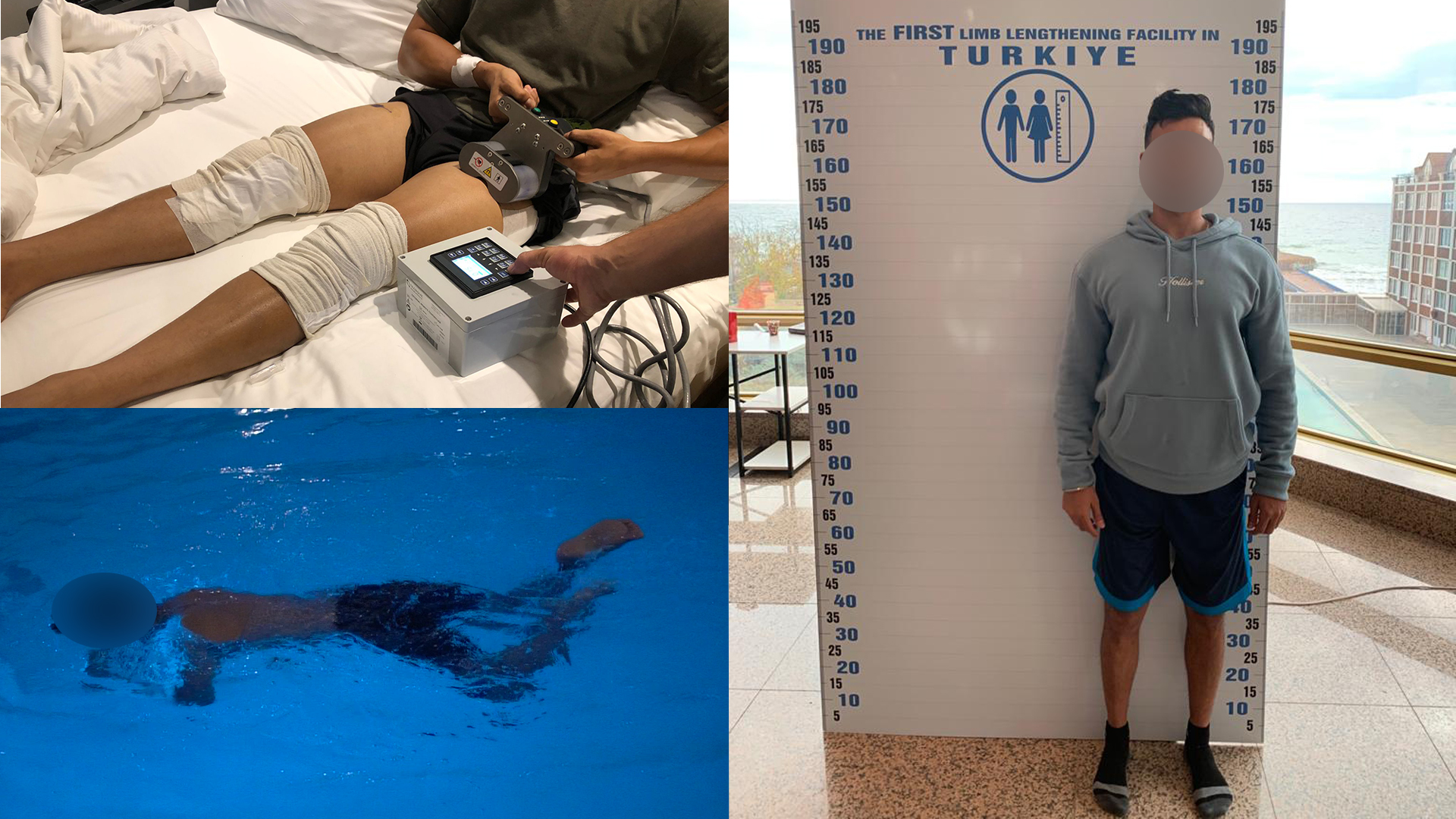 Limb-Lengthening Journey of our American Patient - Wanna Be Taller