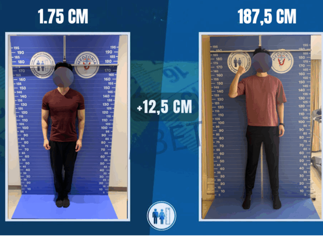 Limb Lengthening Surgery Before and After Patient Gallery - Wanna Be Taller