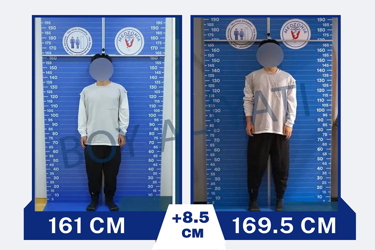 Limb Lengthening Surgery Before and After Patient Gallery - Wanna Be Taller
