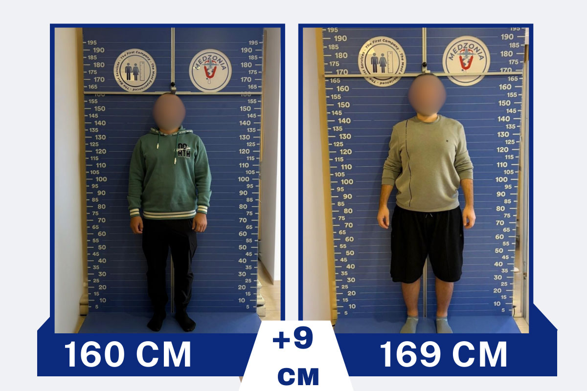 Limb Lengthening Surgery Before and After Patient Gallery - Wanna Be Taller