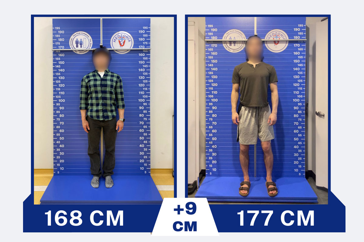 Limb Lengthening Surgery Before and After Patient Gallery - Wanna Be Taller
