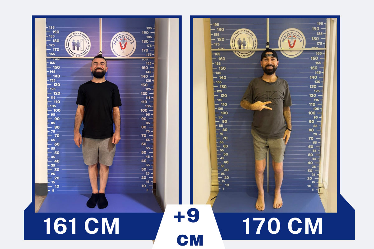 Limb Lengthening Surgery Before and After Patient Gallery - Wanna Be Taller