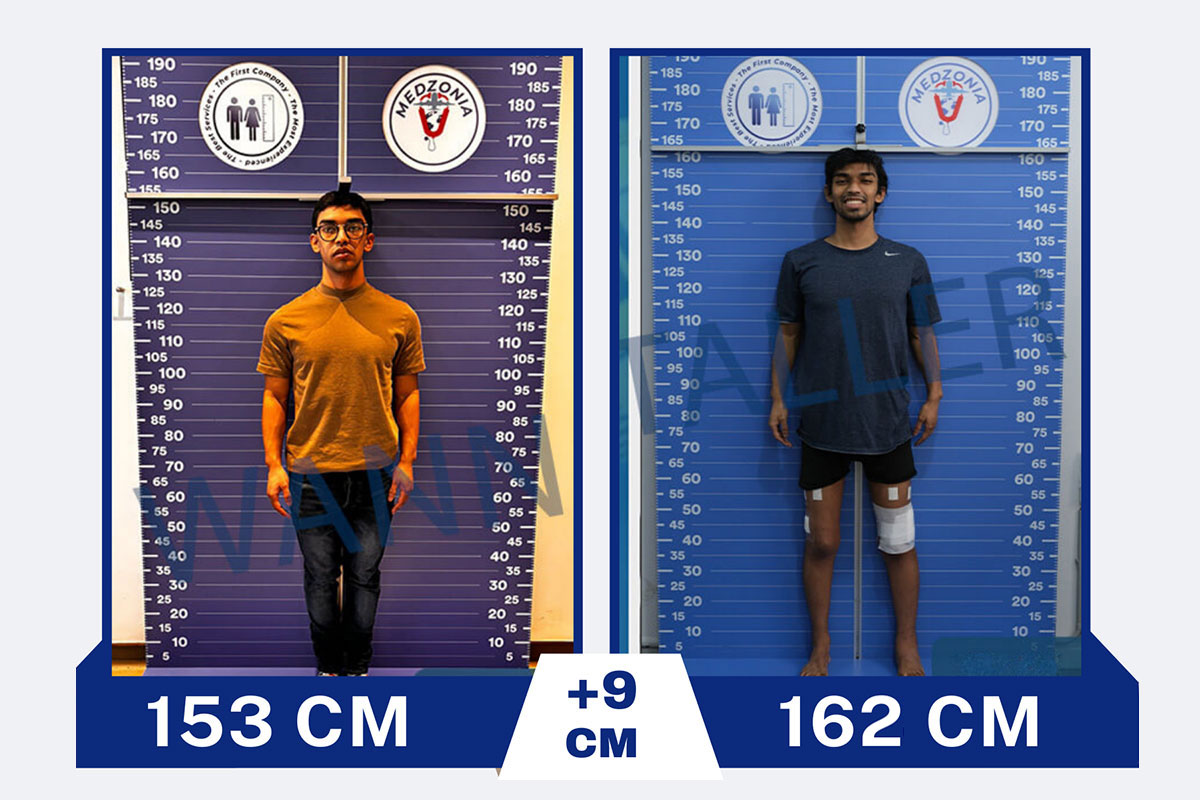 Limb Lengthening Surgery Before and After Patient Gallery - Wanna Be Taller