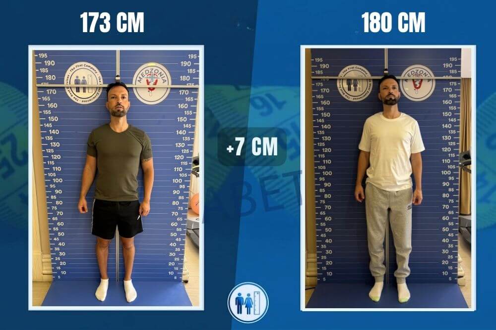 Limb Lengthening Surgery in Turkey | Wanna Be Taller