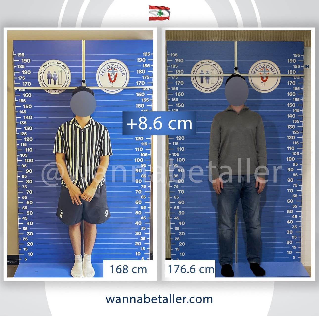 Body Proportions after Limb Lengthening Surgery - Wanna Be Taller