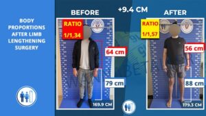 Body Proportions after Limb Lengthening Surgery - Wanna Be Taller