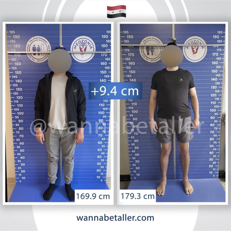 Body Proportions after Limb Lengthening Surgery - Wanna Be Taller