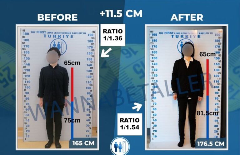 Body Proportions after Limb Lengthening Surgery - Wanna Be Taller