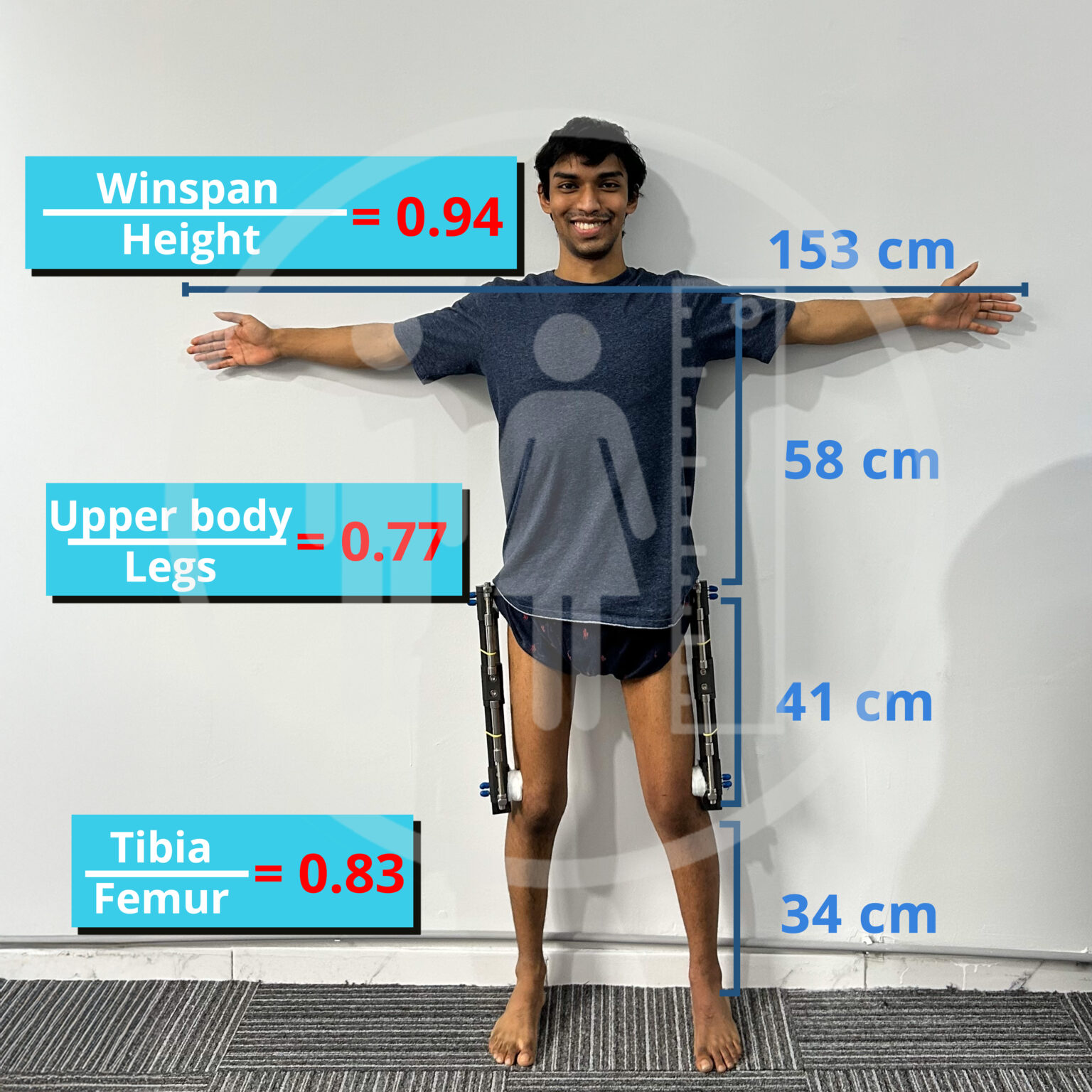 Body Proportions after Limb Lengthening Surgery - Wanna Be Taller