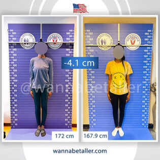 WHAT IS HEIGHT REDUCTION SURGERY? A DETAILED GUIDE - Wanna Be Taller