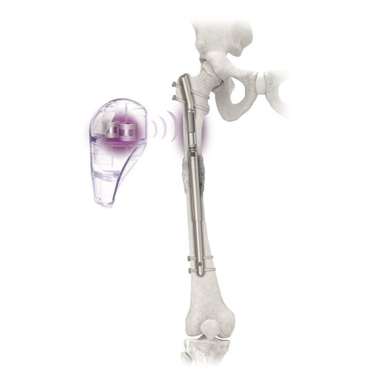 Limb Lengthening with the Precice Max Method - Wanna Be Taller