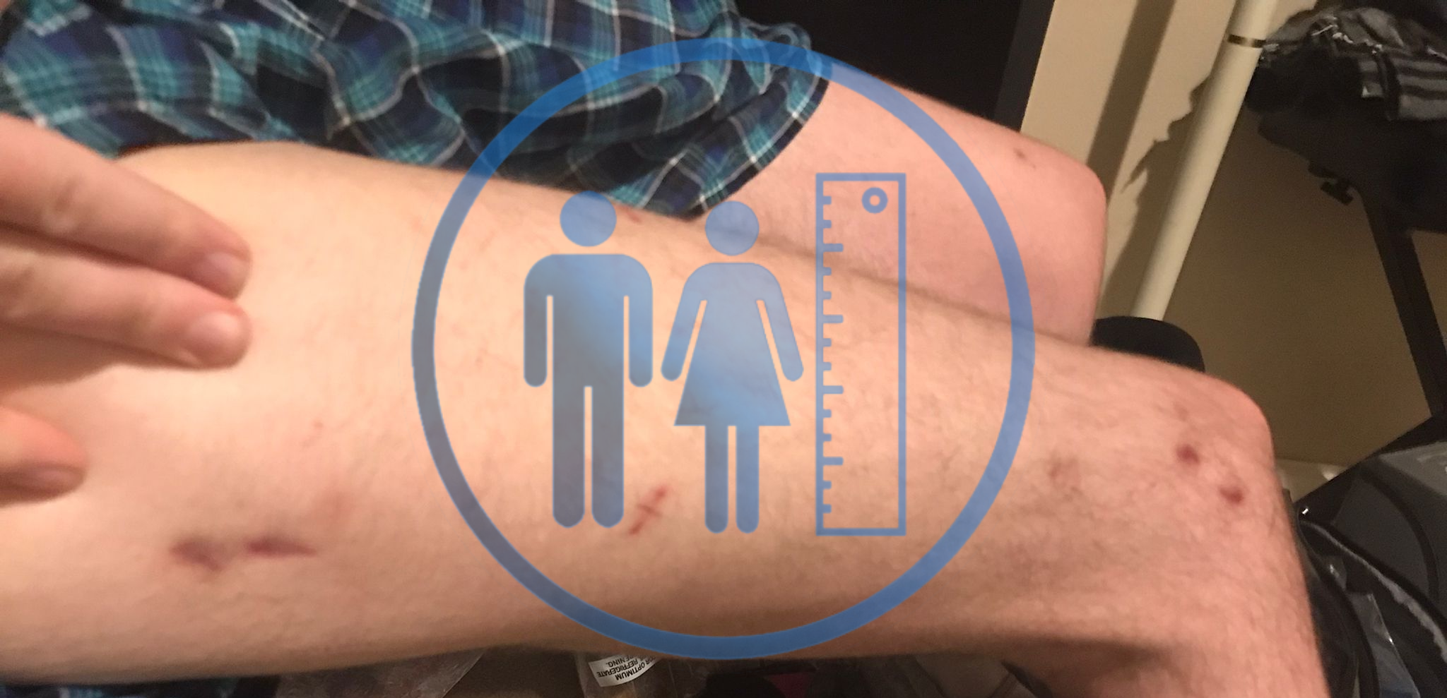 LON (Lengthening Over Nail) Method - Wanna Be Taller